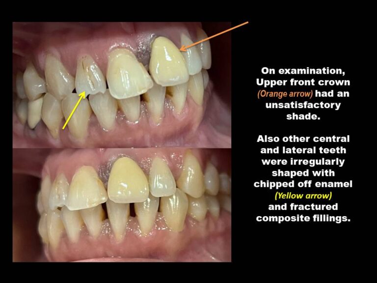 How we changed the smile of this female patient and gave her a ...